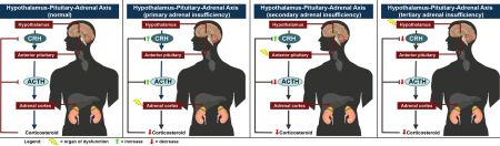 Addison's disease - WikEM