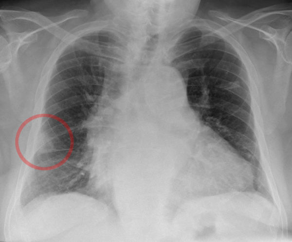 Pulmonary embolism - WikEM