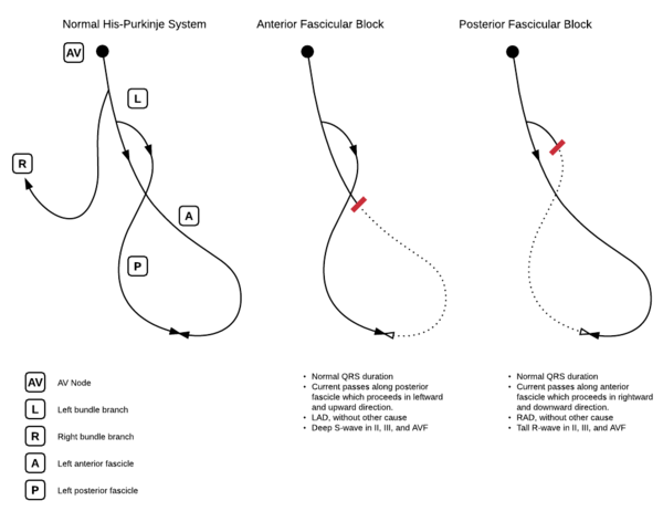 Left anterior fascicular block - WikEM