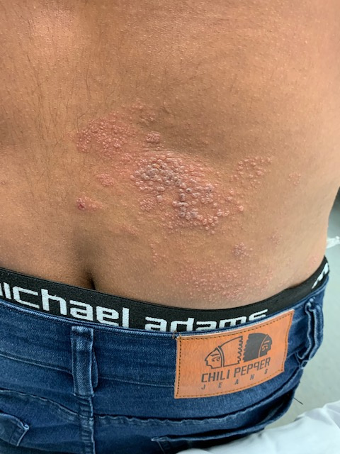 Acute herpes zoster - WikEM