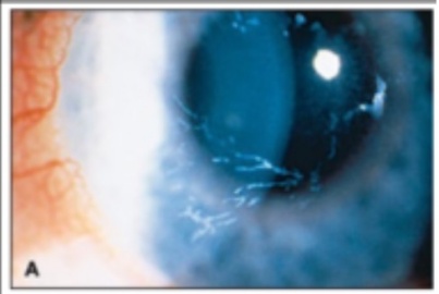 Conjunctivitis (peds) - WikEM