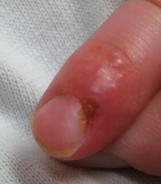 Hand and finger infections - WikEM