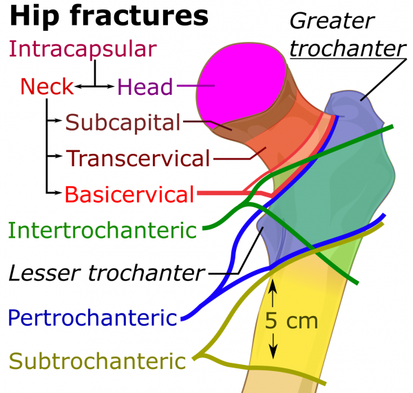 Intertrochanteric femur fracture - WikEM