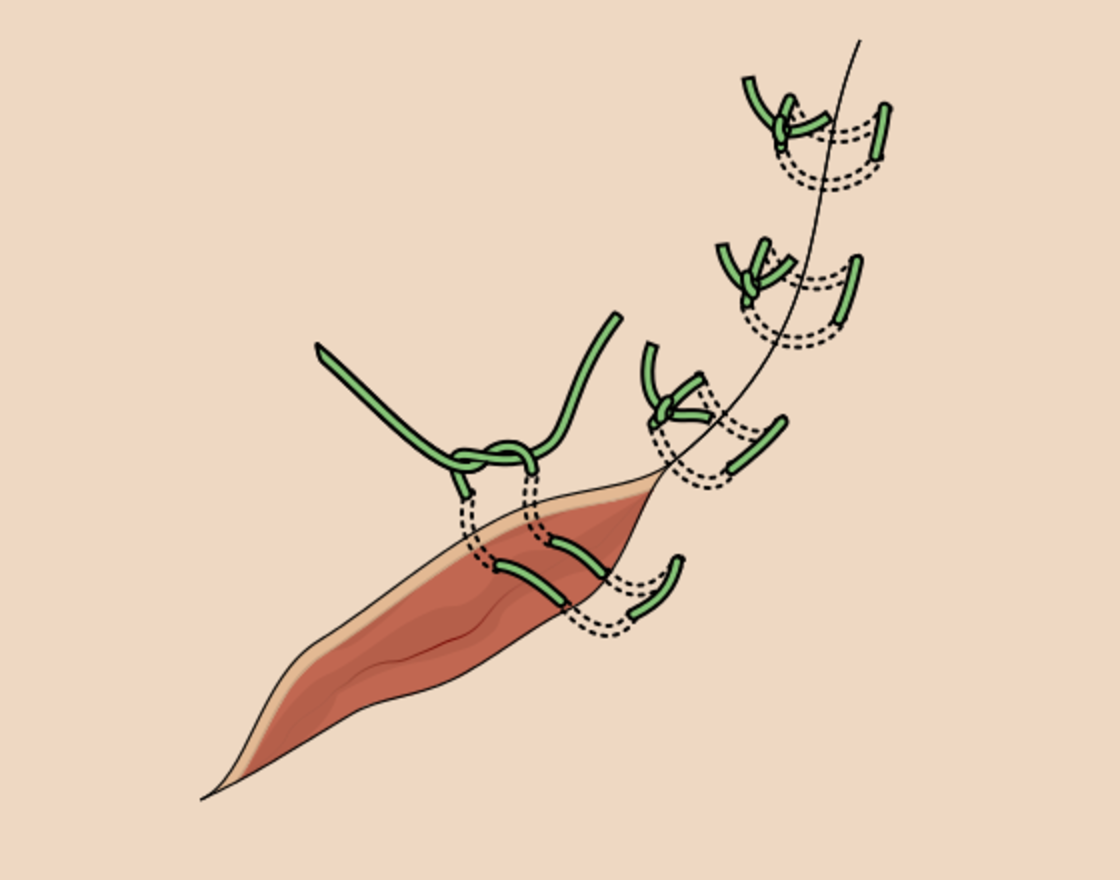 File:Horizontal mattress suture.svg - WikEM