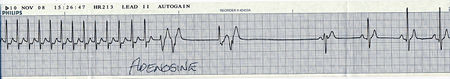 Paroxysmal supraventricular tachycardia - WikEM