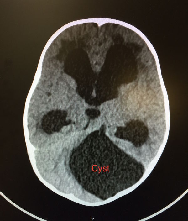 Hydrocephalus - WikEM