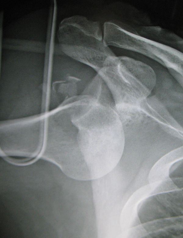 Inferior Shoulder Dislocation Wikem