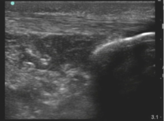 Ultrasound: Tendons - WikEM