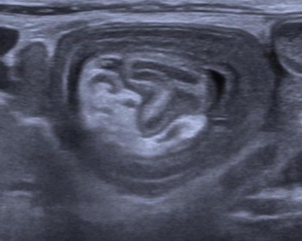 Intussusception - WikEM