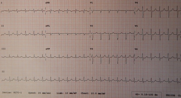 Junctional tachycardia - WikEM