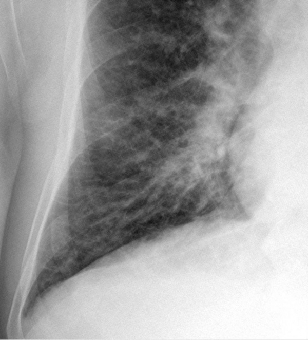 Congestive heart failure - WikEM