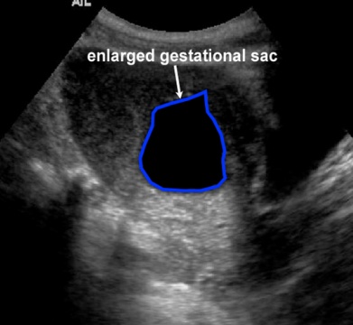 Ultrasound: Pelvic - WikEM