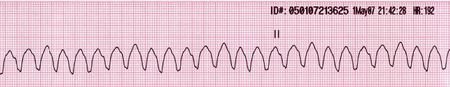 ACLS: Tachycardia - WikEM