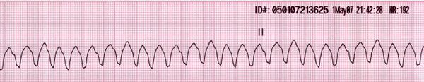 ACLS: Tachycardia - WikEM