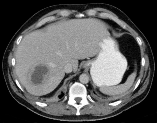 Hepatic abscess - WikEM