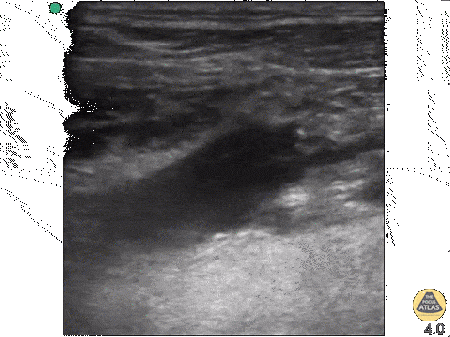 Lemierre's syndrome - WikEM