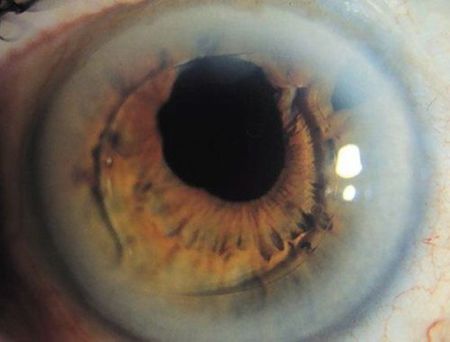 Lens dislocation - WikEM