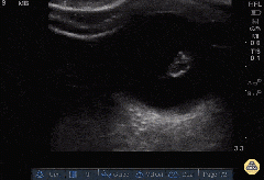 Ocular ultrasound - WikEM