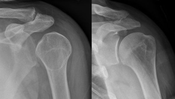 Posterior shoulder dislocation - WikEM