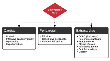 Low ECG voltage - WikEM
