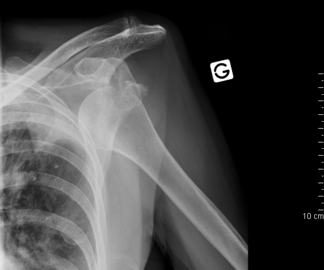 Shoulder dislocation - WikEM