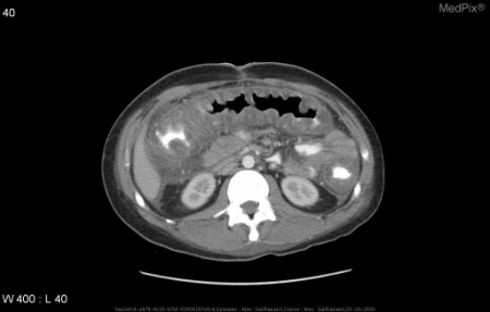 Clostridium difficile - WikEM