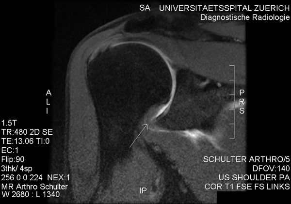 Adhesive capsulitis - WikEM