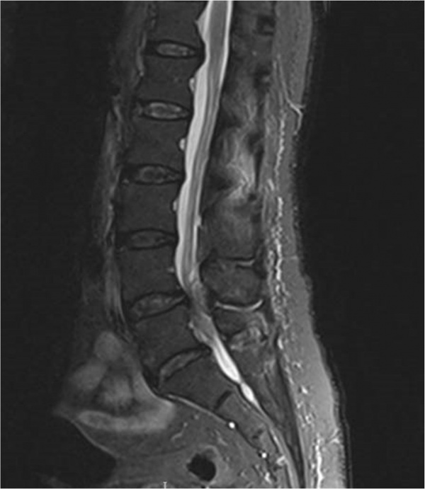 Epidural abscess (spinal) - WikEM