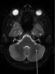 Multiple sclerosis - WikEM