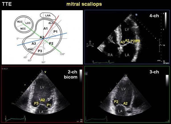 Mitral regurgitation - WikEM