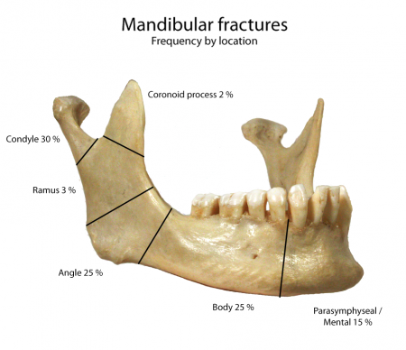 Mandible fracture - WikEM