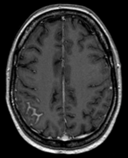 Neoplastic meningitis - WikEM