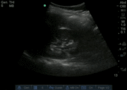 Renal ultrasound - WikEM