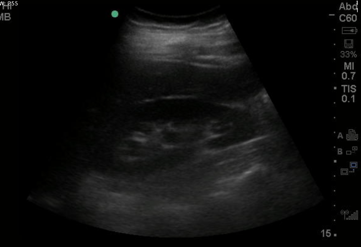 File:Mild hydro.png - WikEM