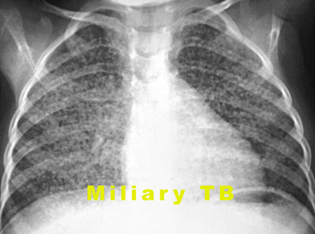 Tuberculosis - WikEM