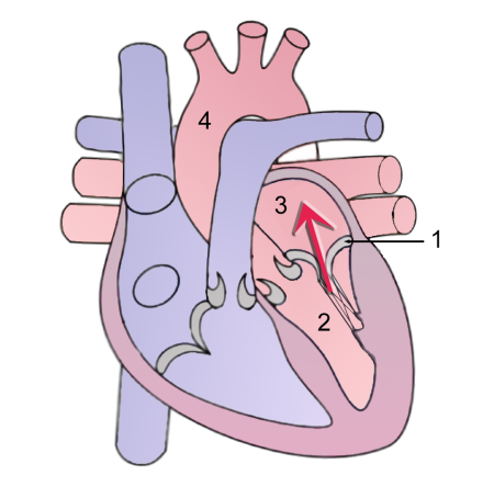 Mitral regurgitation - WikEM