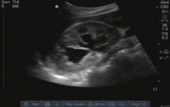 Renal ultrasound - WikEM
