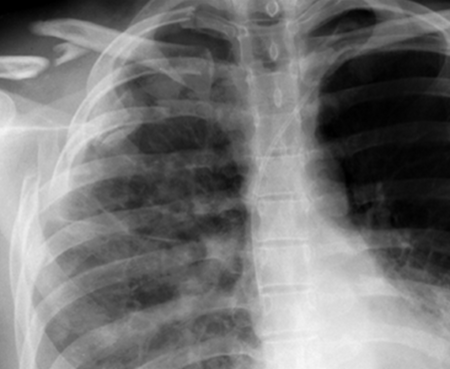 Rib fracture - WikEM