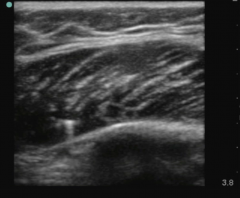 Ultrasound: Soft tissue - WikEM