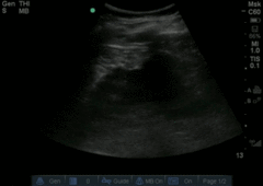 Renal ultrasound - WikEM