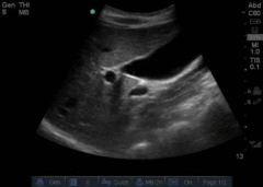 Biliary ultrasound - WikEM