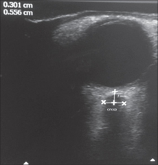 Ocular ultrasound - WikEM