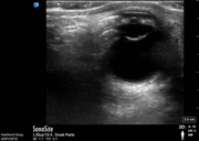 Ocular ultrasound - WikEM