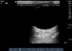Ocular ultrasound - WikEM
