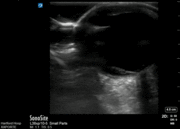 Ocular ultrasound - WikEM