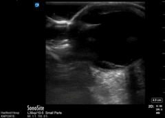 Ocular ultrasound - WikEM