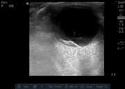 Ocular ultrasound - WikEM