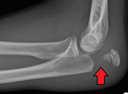 Olecranon fracture - WikEM