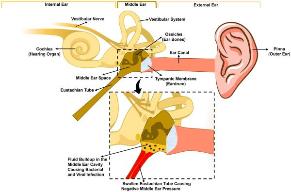 Acute otitis media - WikEM