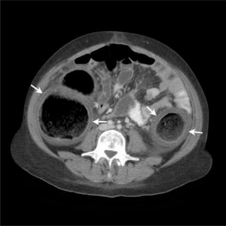 Toxic megacolon - WikEM